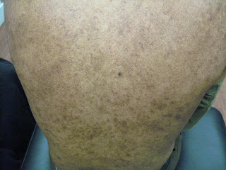 The Armchair Dermatologist: Confluent and Reticulated Papillomatosis (CARP)