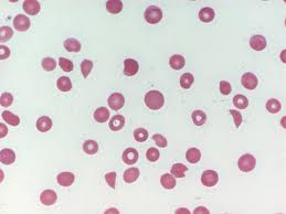 Thrombocytopenia