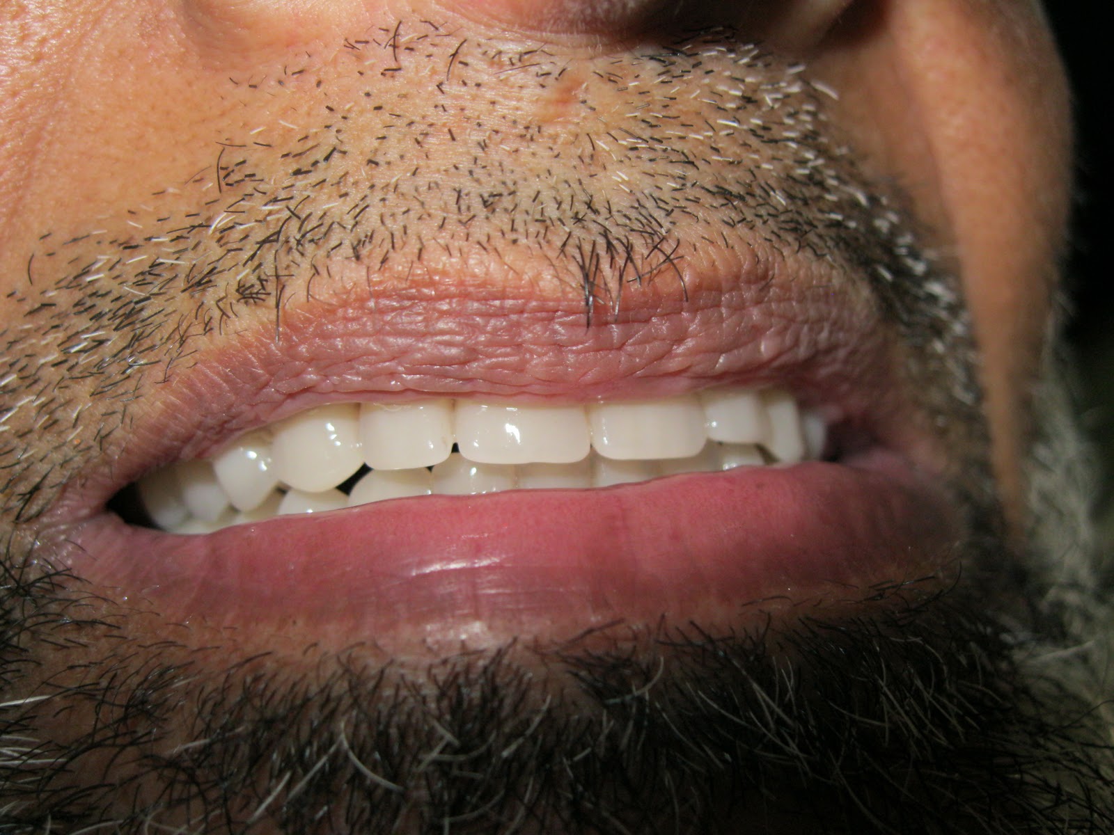 DENTO CARE DENTAL CLINICS: SUNFLEX COMPLETE DENTURE