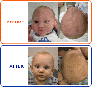 Claire's Cranio Story: Q&A and Pictures