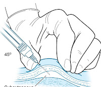 PEDKNH: การฉีดยาเข้าใต้ผิวหนัง (Subcutaneous Injection)