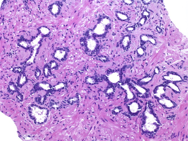 student_topics: Prostate Atrophy (slides)