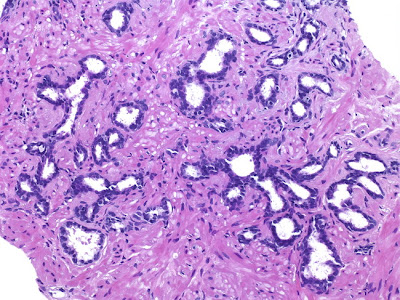 student_topics: Prostate Atrophy (slides)