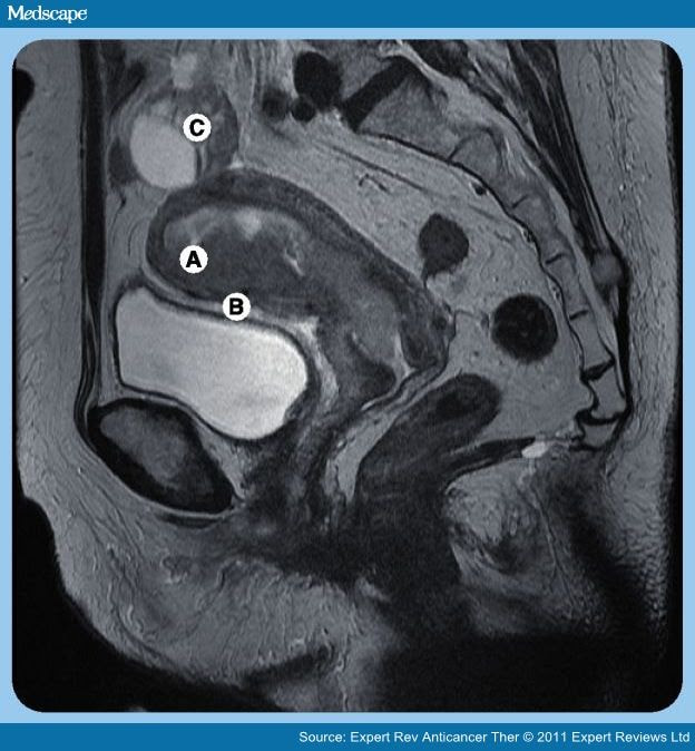 Most Cancers Cervix Mri Radiographics