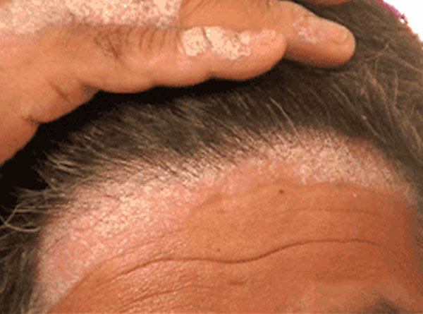 Eczema In Hair Treatment Doctor Heck